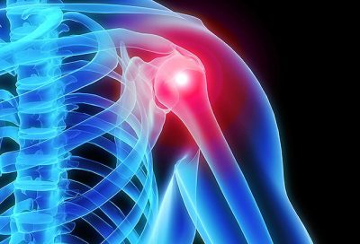 Shoulder Impingement Syndrome - Orthopedic Physical Therapy